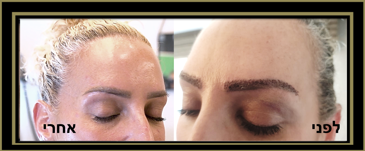 השתלת גבות - The Israeli Hair Transplant Center - המרכז להשתלות שיער