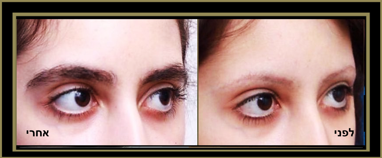 השתלת גבות - The Israeli Hair Transplant Center - המרכז להשתלות שיער